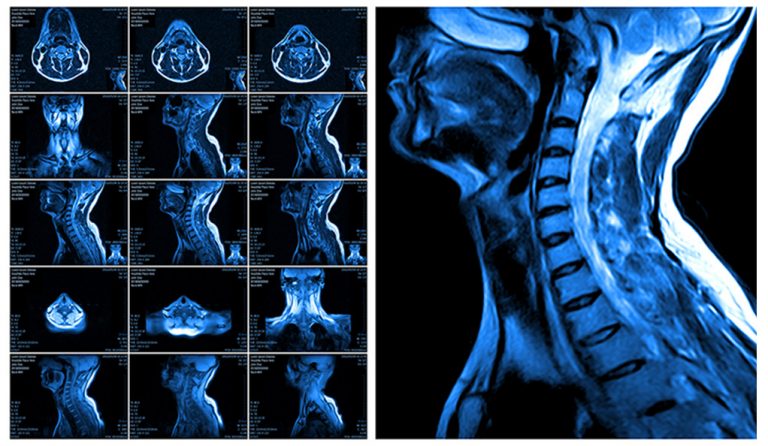 MRI of the neck (cervical spine) Kelowna – Open MRI of Canada